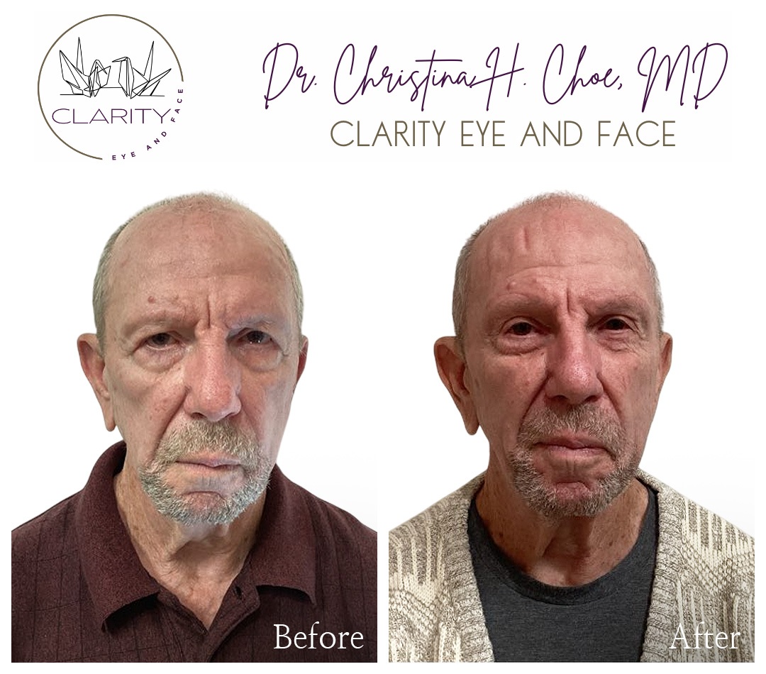 Before and After Brow Lift Photo | Clarity Eye and Face