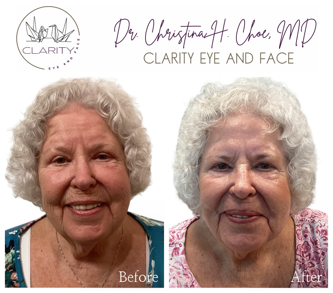 Before and After CO2 laser resurfacing Photo | Clarity Eye and Face