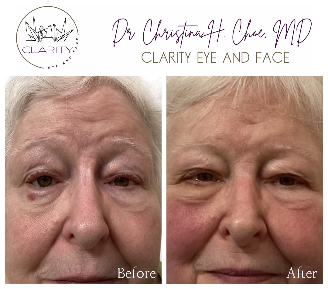 Before and After Entropion Photo | Clarity Eye and Face
