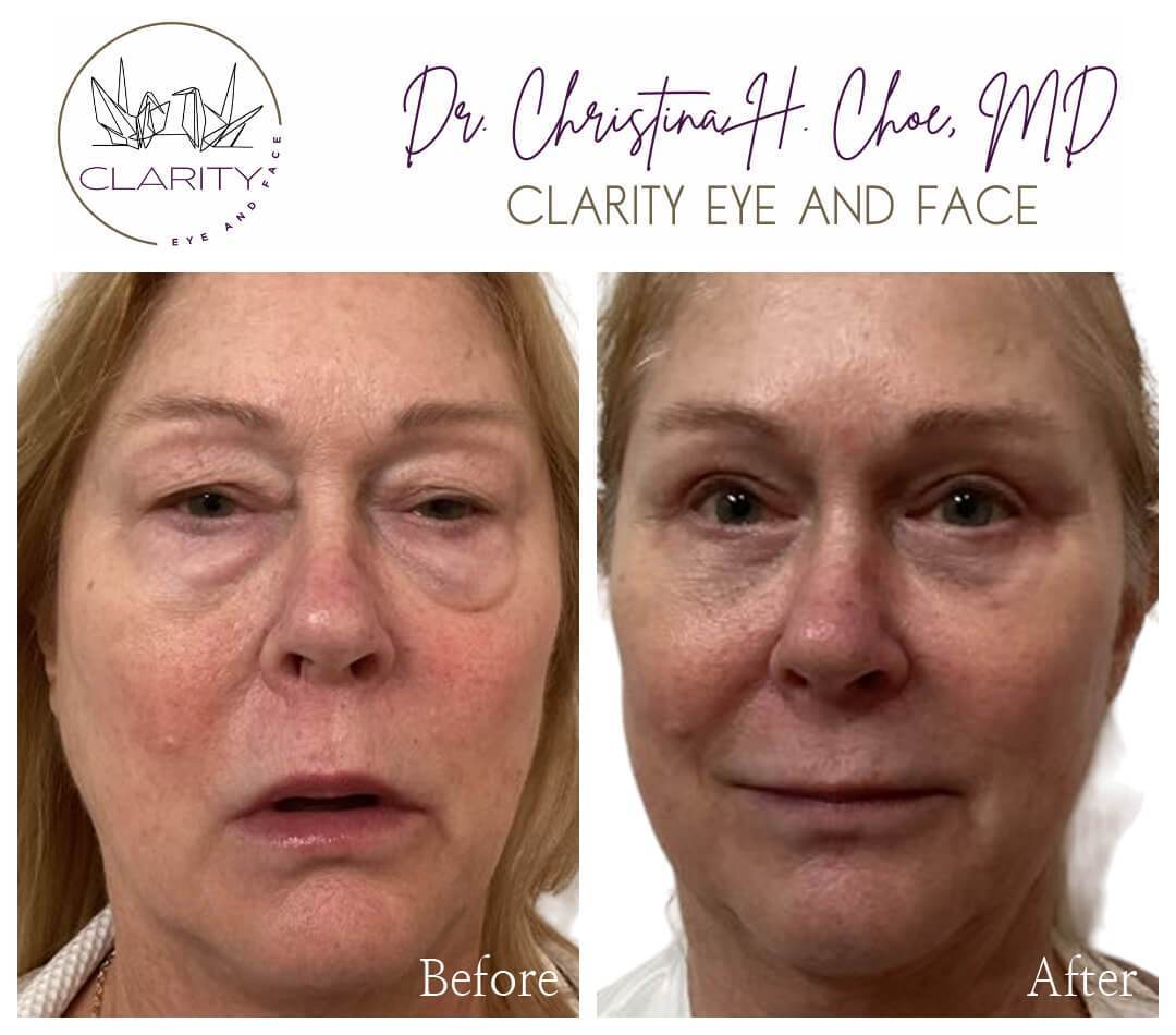 Before and After Lower Blepharoplasty Photo | Clarity Eye and Face