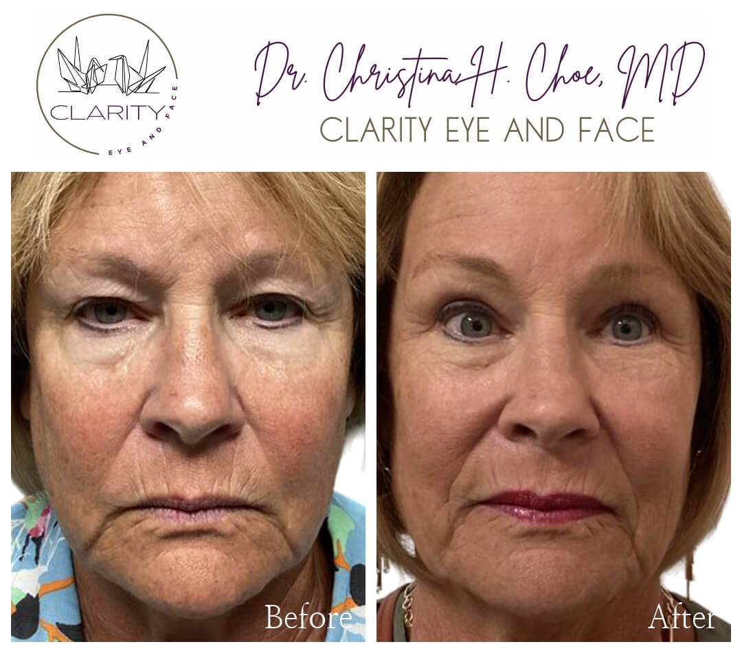 Before and After Upper Blepharoplasty Photo | Clarity Eye and Face