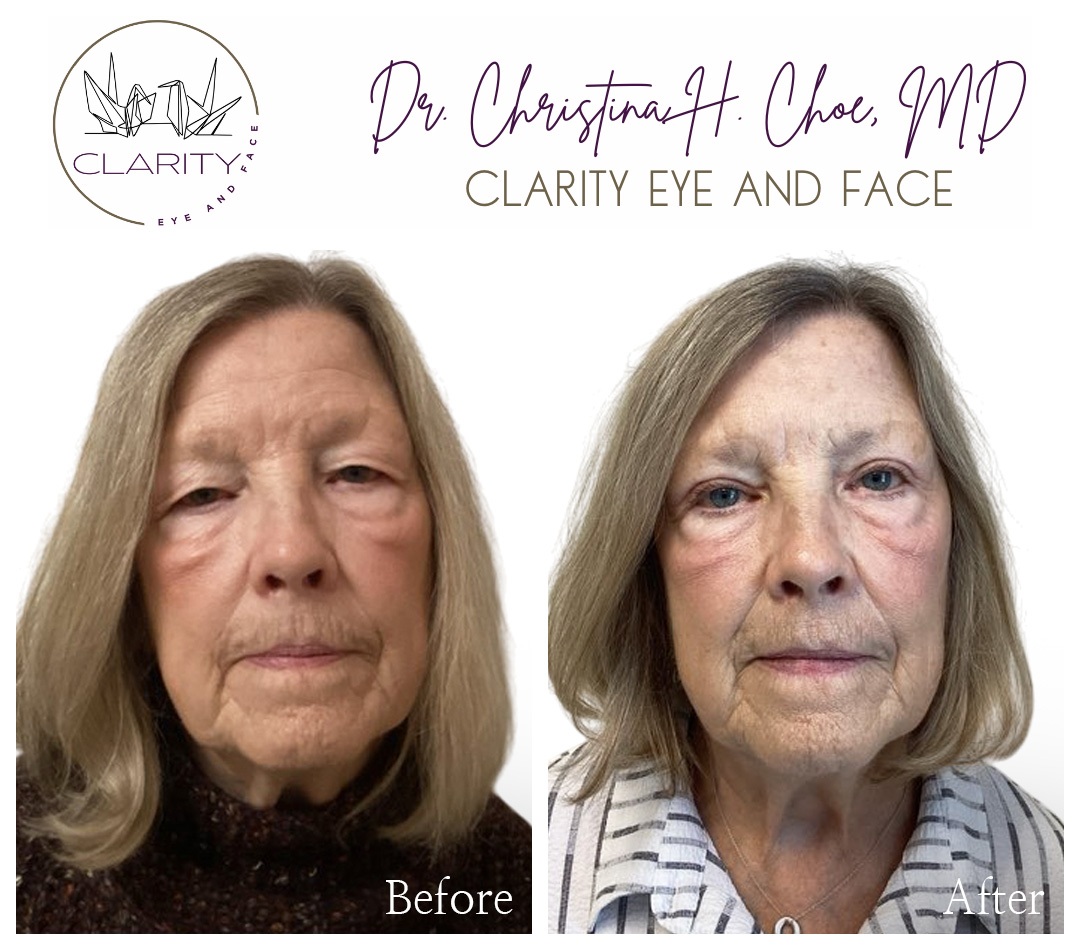 Before and After Upper Blepharoplasty Photo | Clarity Eye and Face