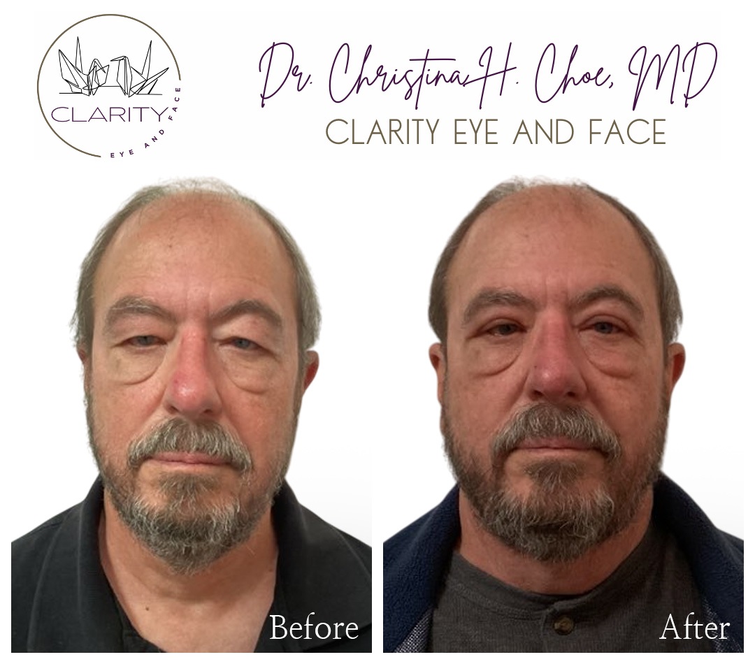 Before and After Upper Blepharoplasty Photo | Clarity Eye and Face
