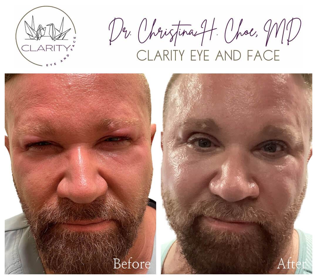 Before and After Upper Blepharoplasty Photo | Clarity Eye and Face